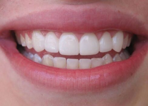 Qué se sabe sobre el medicamento que podría regenerar los dientes ...